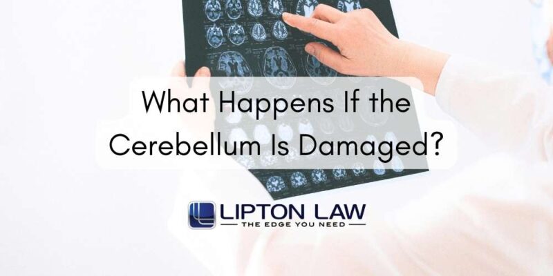 What Happens If the Cerebellum Is Damaged? | MI | Lipton Law