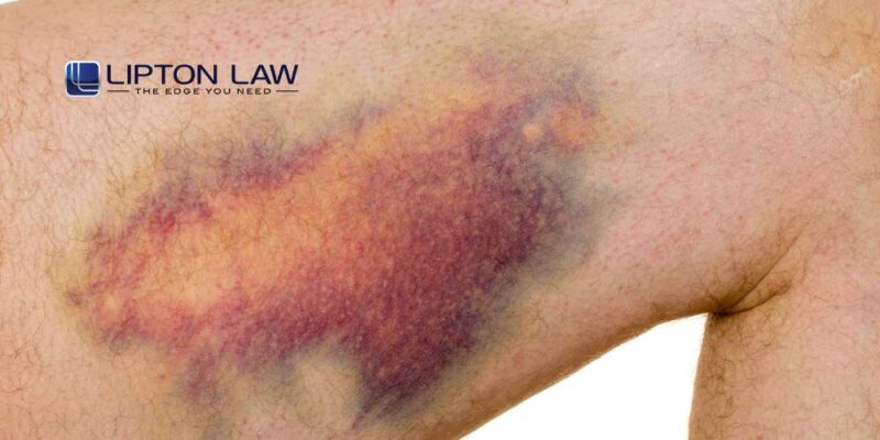 11 Symptoms to Look for After a Fall | Lipton Law | Southfield, MI
