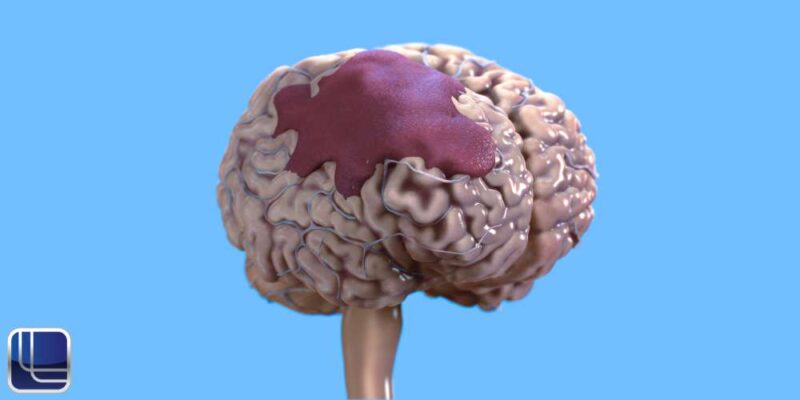 Brain Bleed from Car Accident: What to Know | Lipton Law | MI
